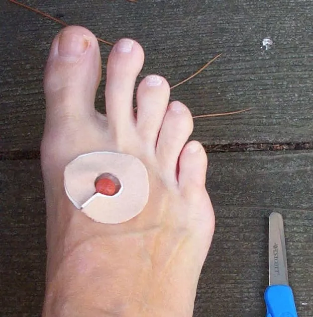 How To Treat Blisters on Feet: During and After Hiking and Walking
